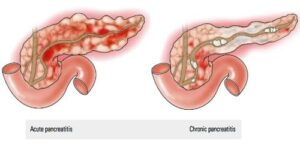 PANCREATITE SINTOMAS CAUSAS E TRATAMENTOS - Dra Sandra Chagas